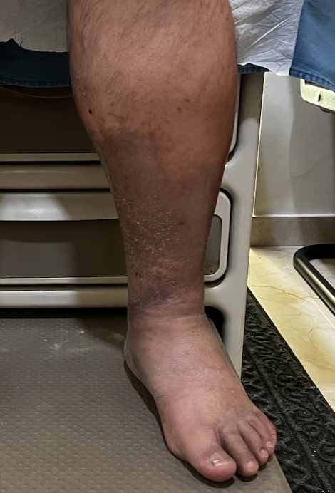 Grados várices – Dr Varices