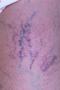 Grados várices – Dr Varices